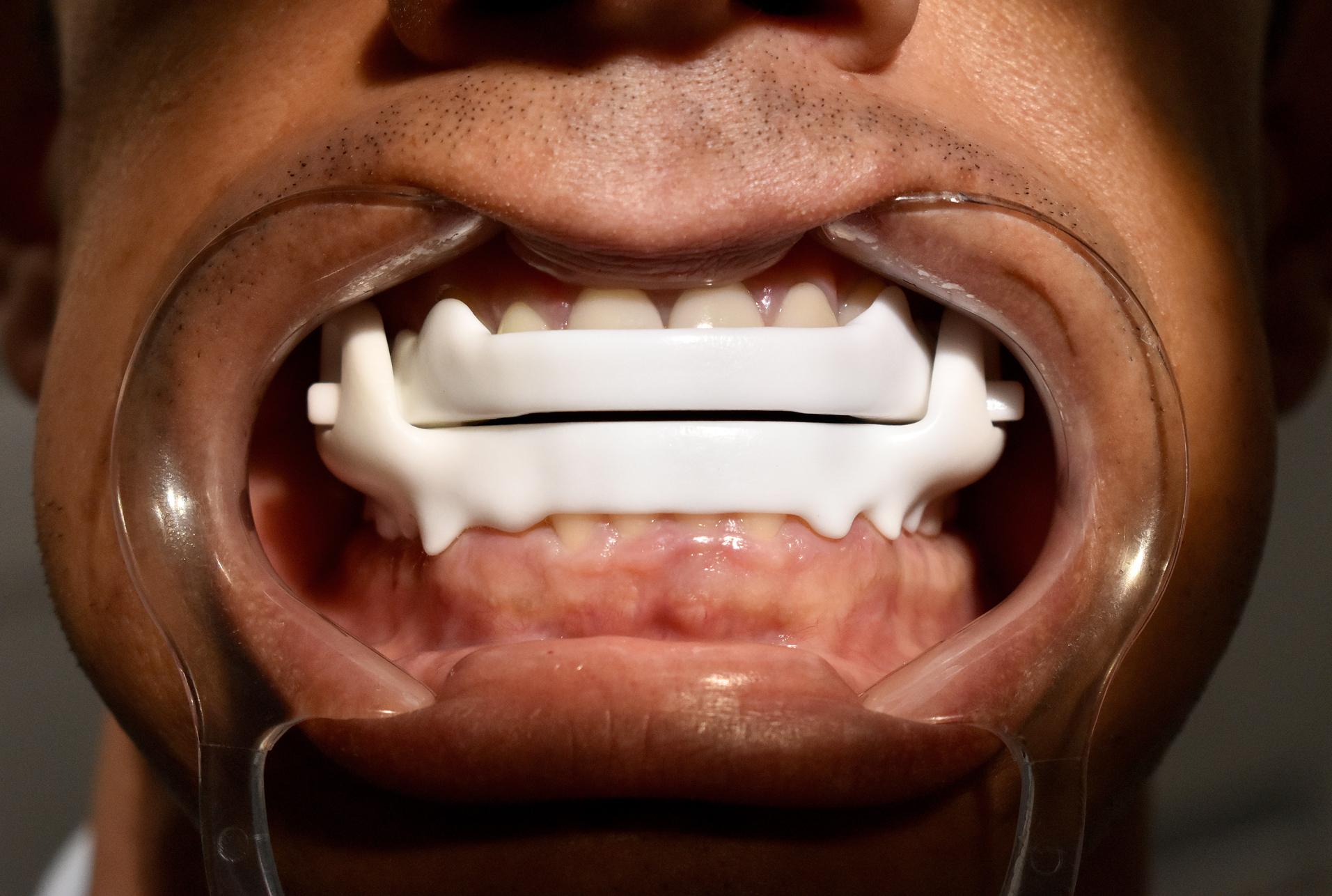 Cómo Funcionan los Dispositivos Orales para Tratar la Apnea del Sueño ...