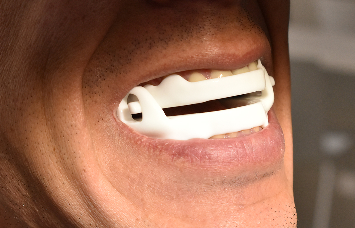 What are mandibular advancement devices (MADs)? - OrthoApnea